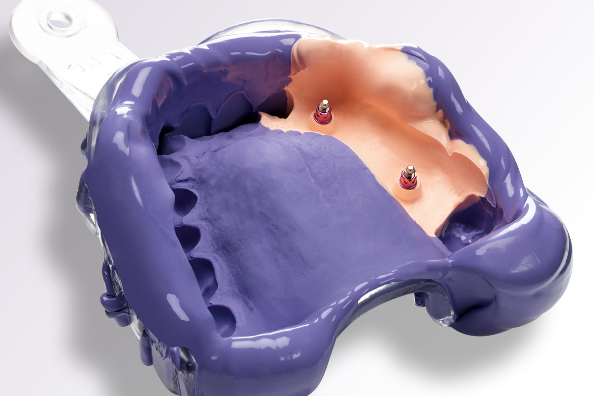 Impressions on parallel and slanting implants: critical issues and use ...