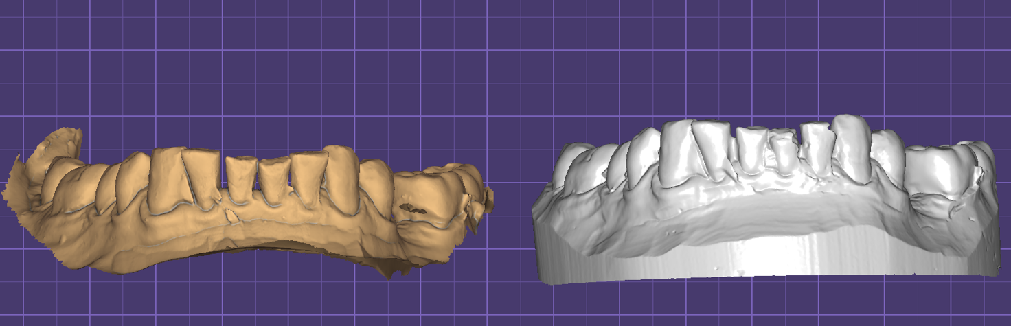 Digital impressions vs analogical impressions: when to use one and when ...