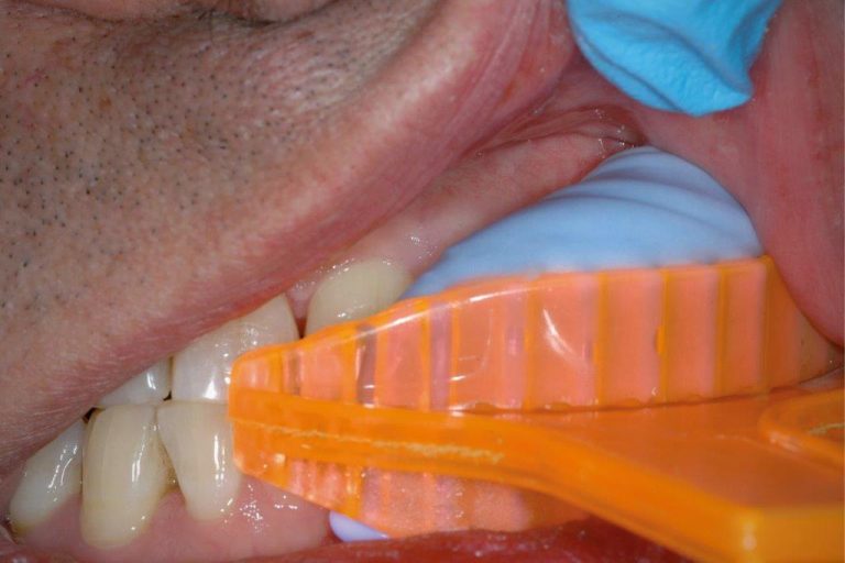 The dual arch impression taking